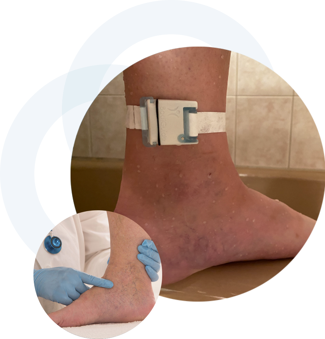Peripheral Edema Monitoring - Bodiguide Inc.